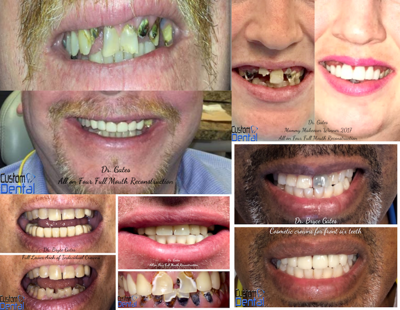 Before and After - Custom Dental of The Colony | The Colony TX